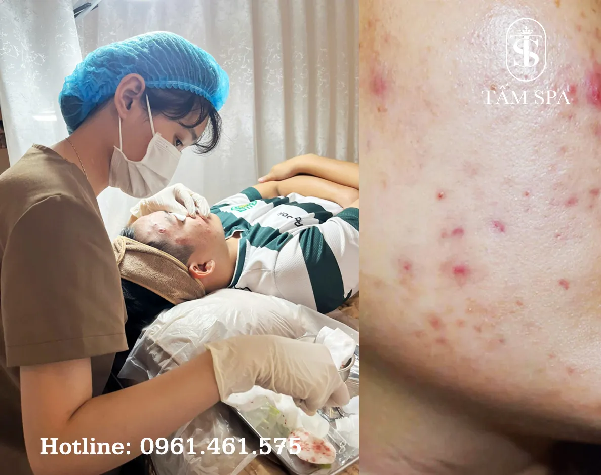 Lấy Nhân Mụn Chuẩn Y Khoa Cơ Bản Bí Quyết Chăm Sóc Da Hiệu Quả